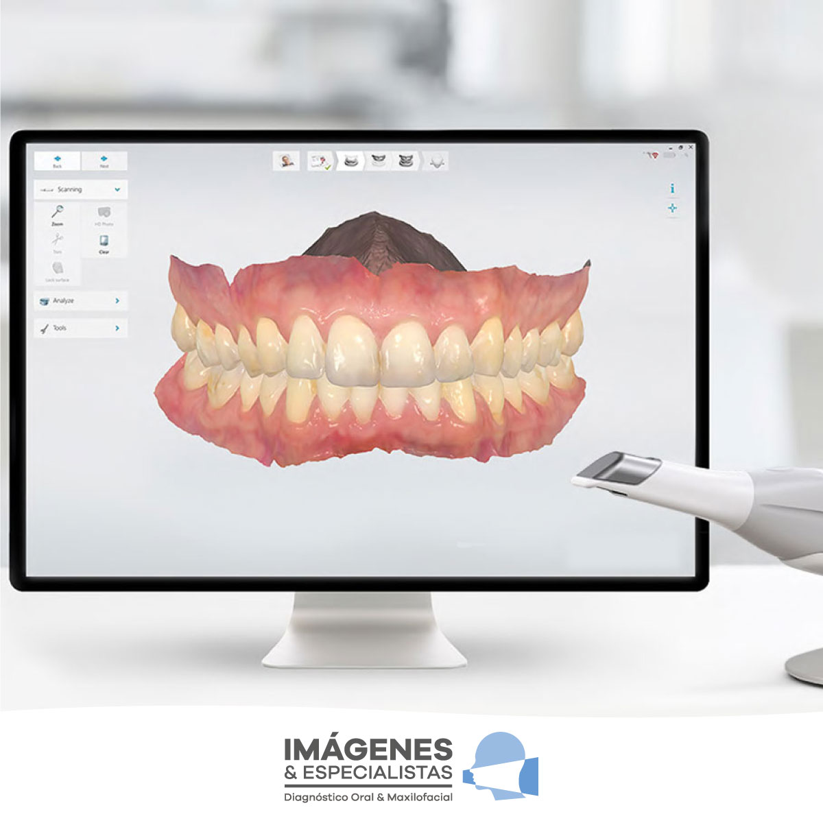 Escaneo Intraoral - Imágenes y Especialistas